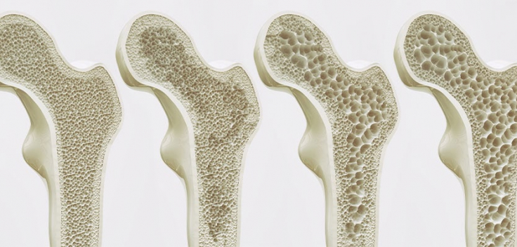 Is Osteoporosis Infusion Therapy Right for You? Learn More